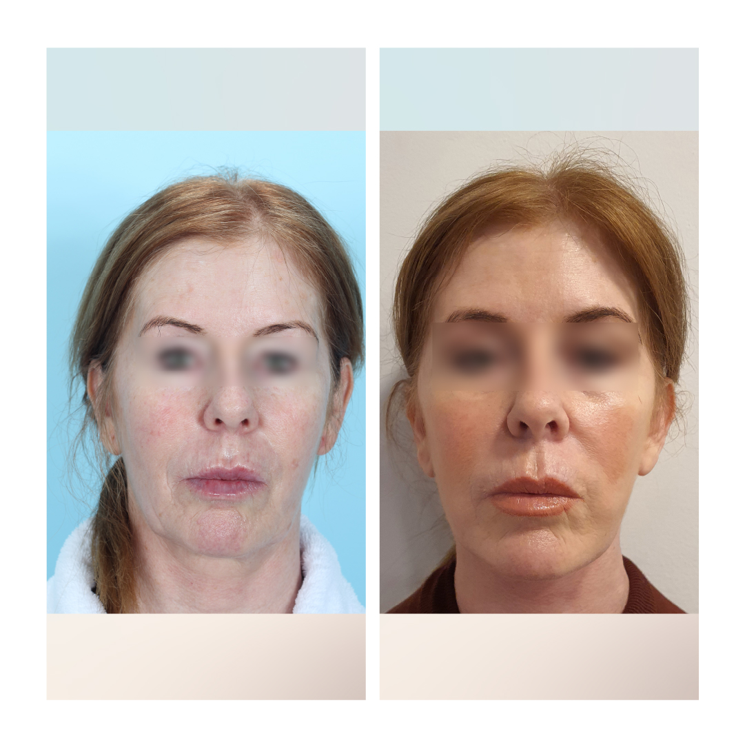 Veido operacijos- fi clinica