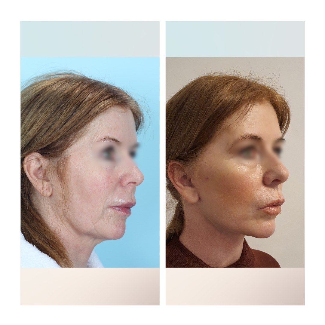 Veido operacijos- fi clinica